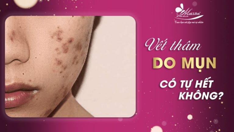 Vết Thâm Mụn Có Tự Hết Không? Cách Trị Thâm Mụn Nặng HIỆU QUẢ?
